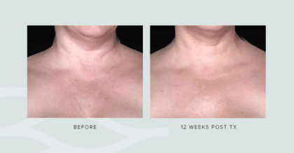 NEW treatments to rejuvenate the neck with Dr. Jacky Lo | Project Skin MD®